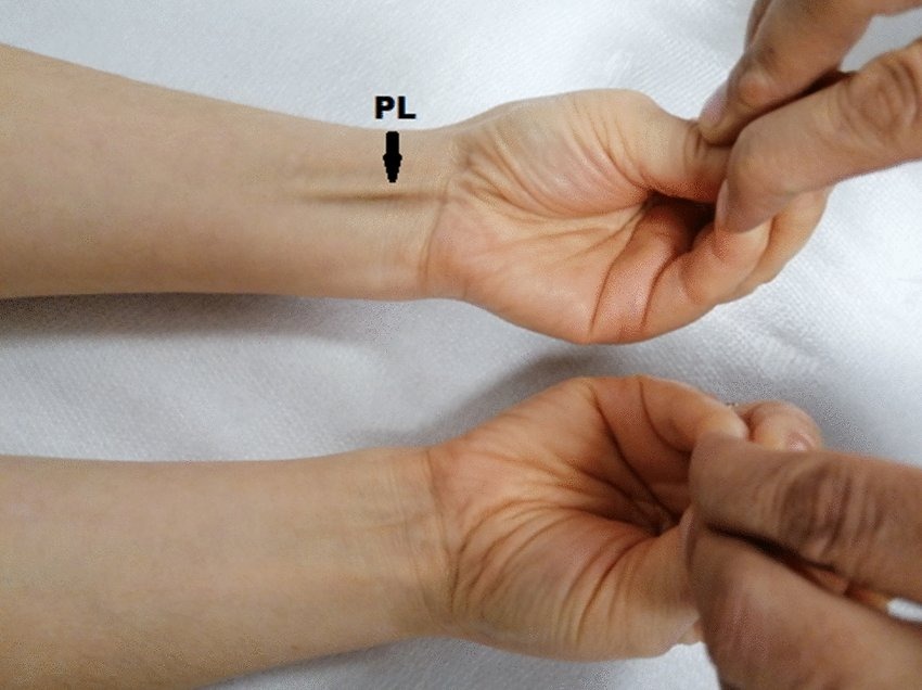 Tại sao một số người không có cơ palmaris longus?