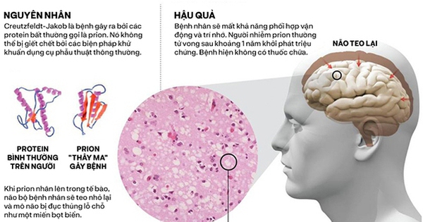 Cảnh giác trước Prion: Một căn bệnh "zombie" có khả năng lây nhiễm loài ...